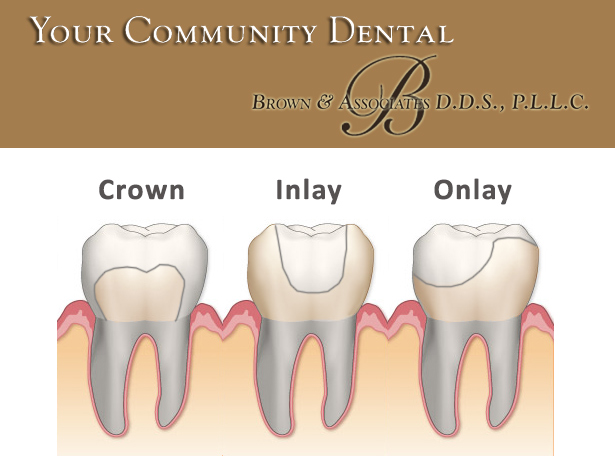Tooth Inlays Onlays & Crowns