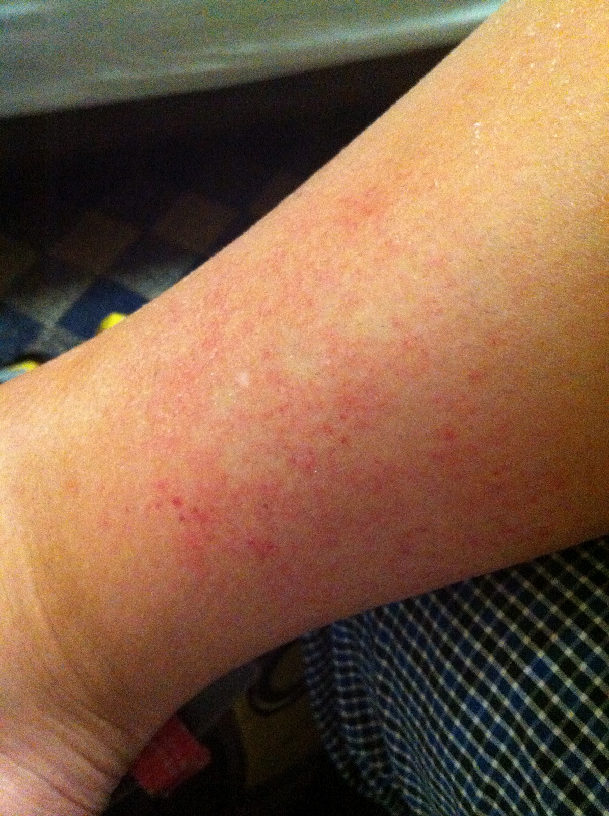 Acid Rain Effects On Human Skin