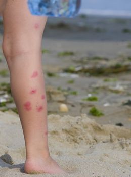 Mengobati Gatal Di Kaki Dengan Mudah