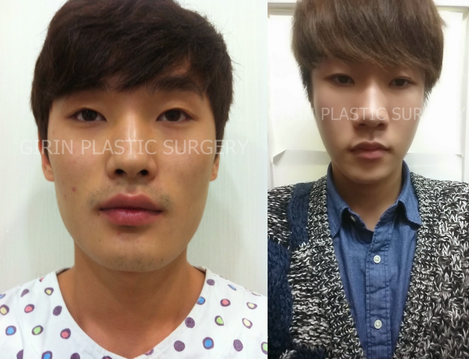 [GIRIN Plastic Surgery] Girin Review: New V-Line & 3D Zygoma Reduction