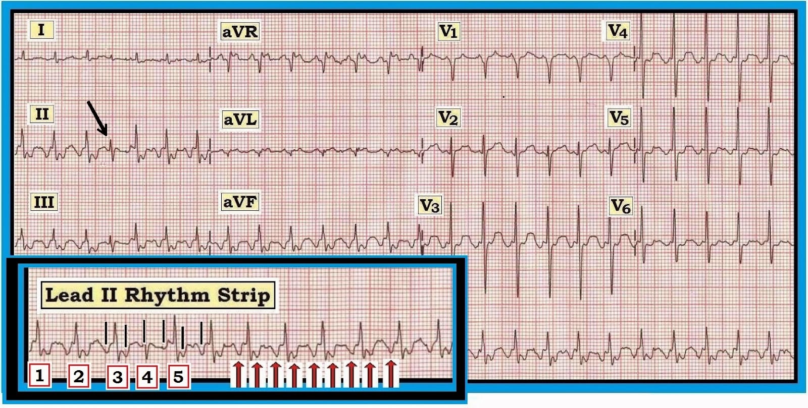 Atrial Flutter | INA - ECG