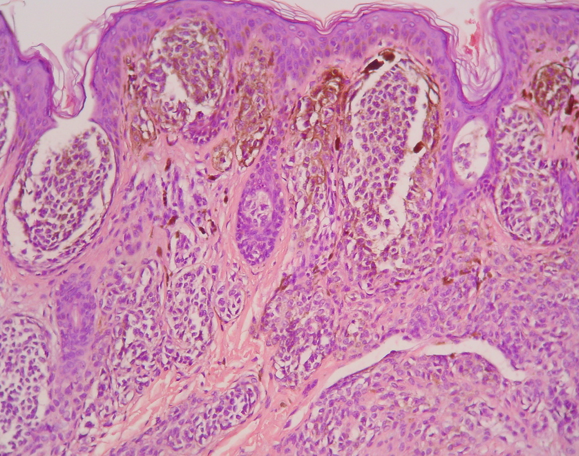dermatopatologia para iniciantes: NEVOS MELANOCÍTICOS USUAIS
