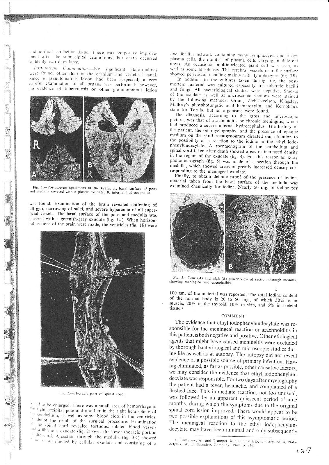 Myelogram Killer: 6. 3-Pantopaque, 1-Myodil Medical Murder Cases