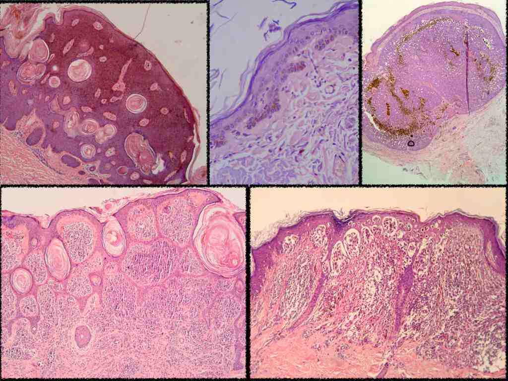 dermatopatologia para iniciantes: LESÃO PIGMENTADA X MELANOCÍTICA ...