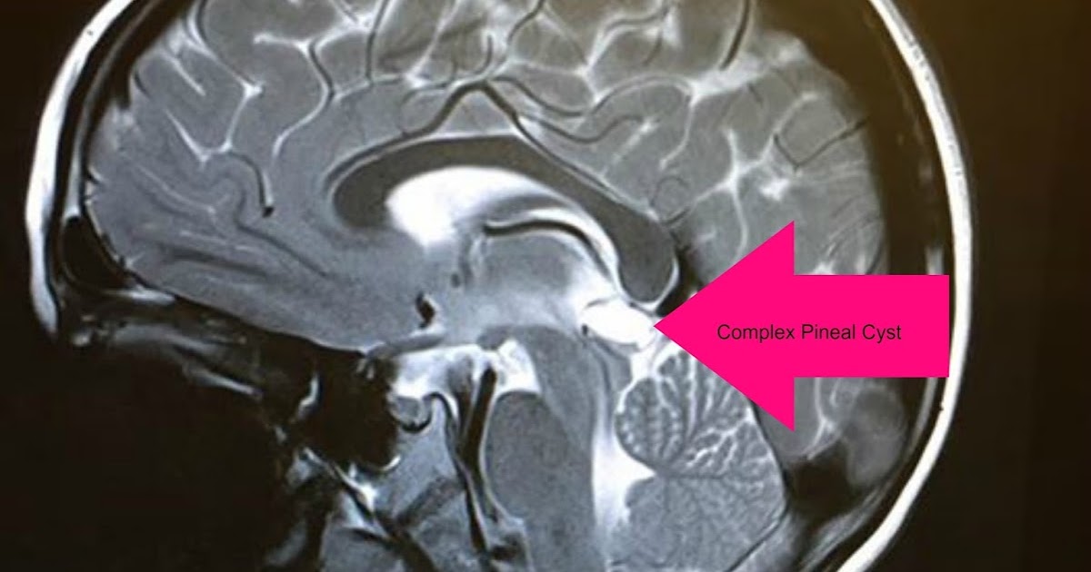 Tales of Mommyhood: Learning About Complex Pineal Cysts and My Kids Brain