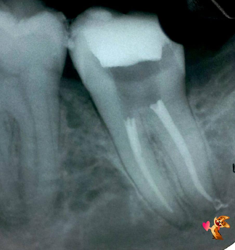 Descobrindo e explorando a Endodontia : Periodontite Apical Primária ...