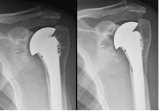 UW Shoulder and Elbow Academy: Principles of glenoid component design ...