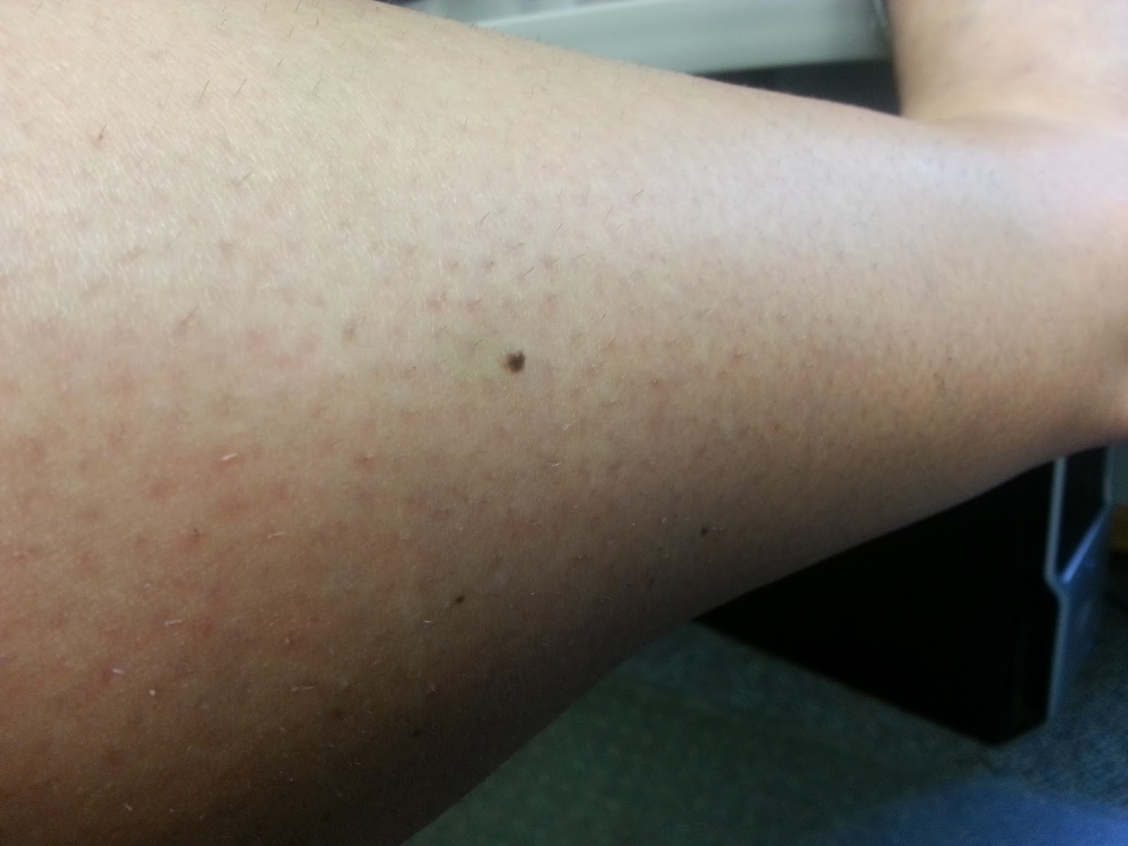 Skin Check - You Are Your Best Advocate for Your Health ~ Christie Koester