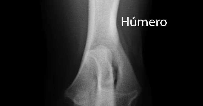 ARTROVET: Fractura del proceso lateral del cóndilo humeral