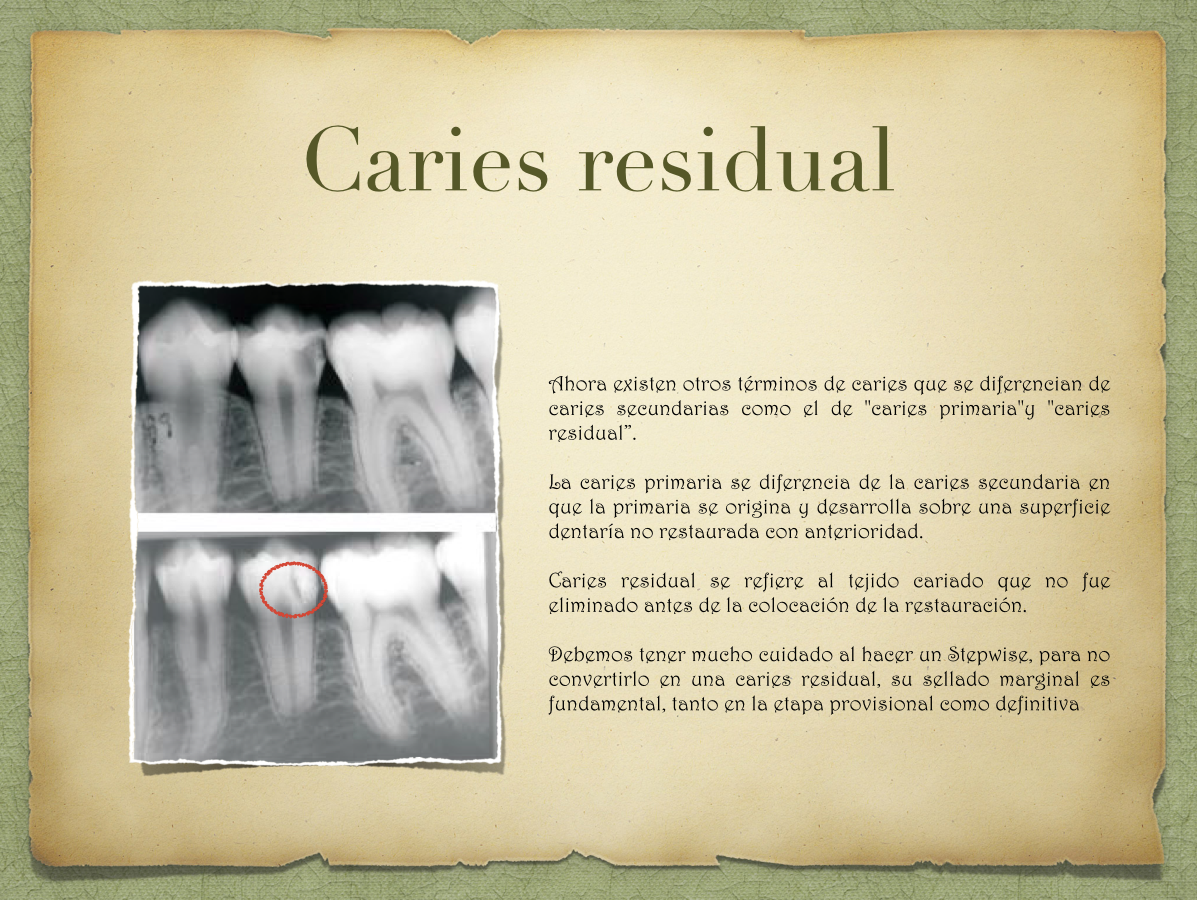 Integral 2015 Dra. Cerda: Seminario 8: Recidiva de caries, caries ...
