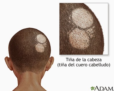 MEDICINA TRADICIONAL CHINA: ENFERMEDADES CAUSADAS POR HONGOS TIÑA o TINEA