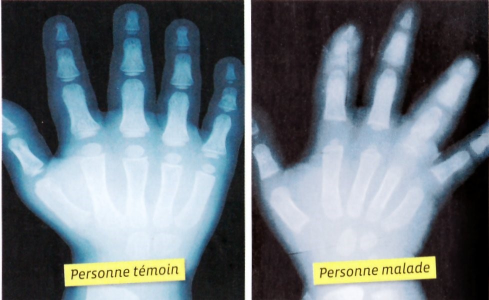 TPE Drépanocytose: La variabilité de la maladie