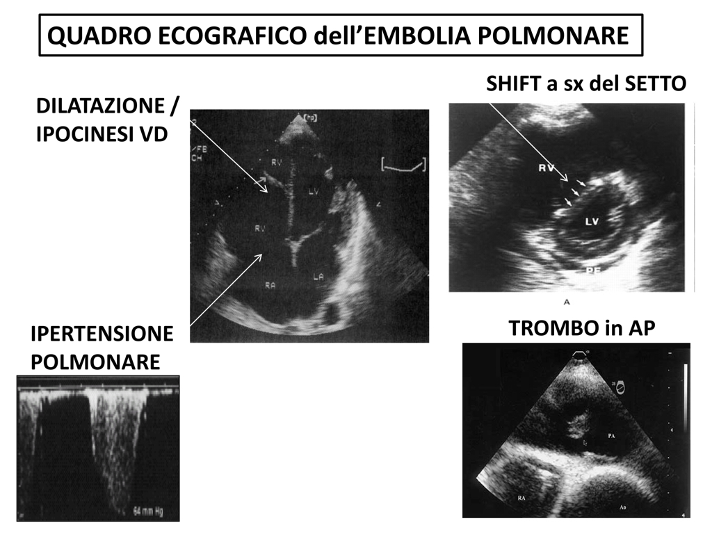 Manuali di Medicina Intensiva: Embolia polmonare - management e terapia ...
