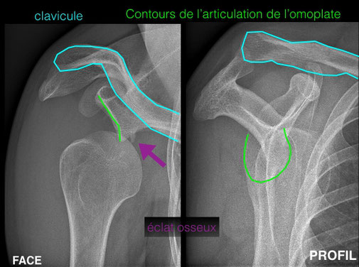 LUXATIONS TRAUMATIQUE DE L’ÉPAULE | Orthopédie &Traumatologie
