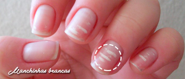 Unhas podem sinalizar problemas de saúde - Beth Biologia