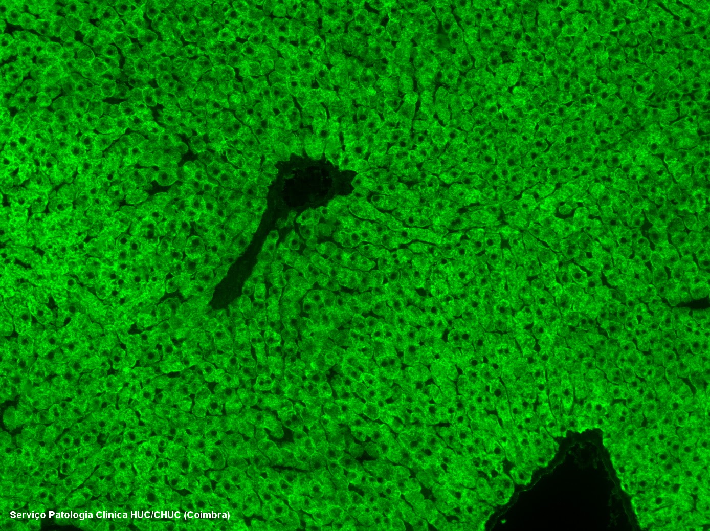 Anticorpos anti - LKM1