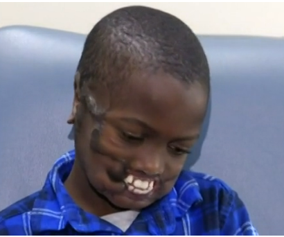 Eliora Gist Blog: Photos -Chimpanzee Attack Survivor To Get Rare Facial ...