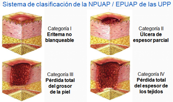¿Cuáles son los estadios de las úlceras?