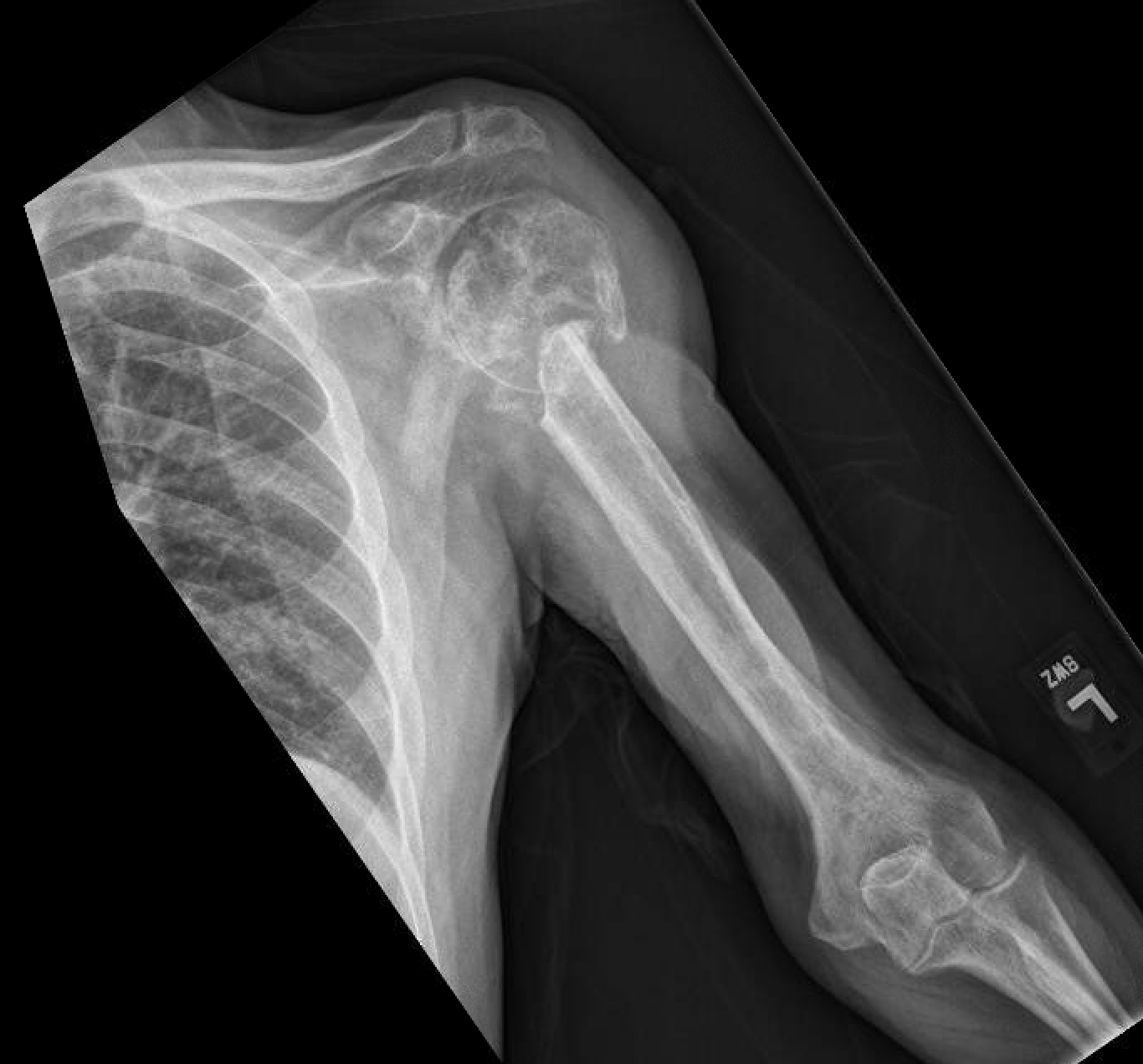 Shoulder and Elbow Surgery: Reverse shoulder replacement for chronic ...