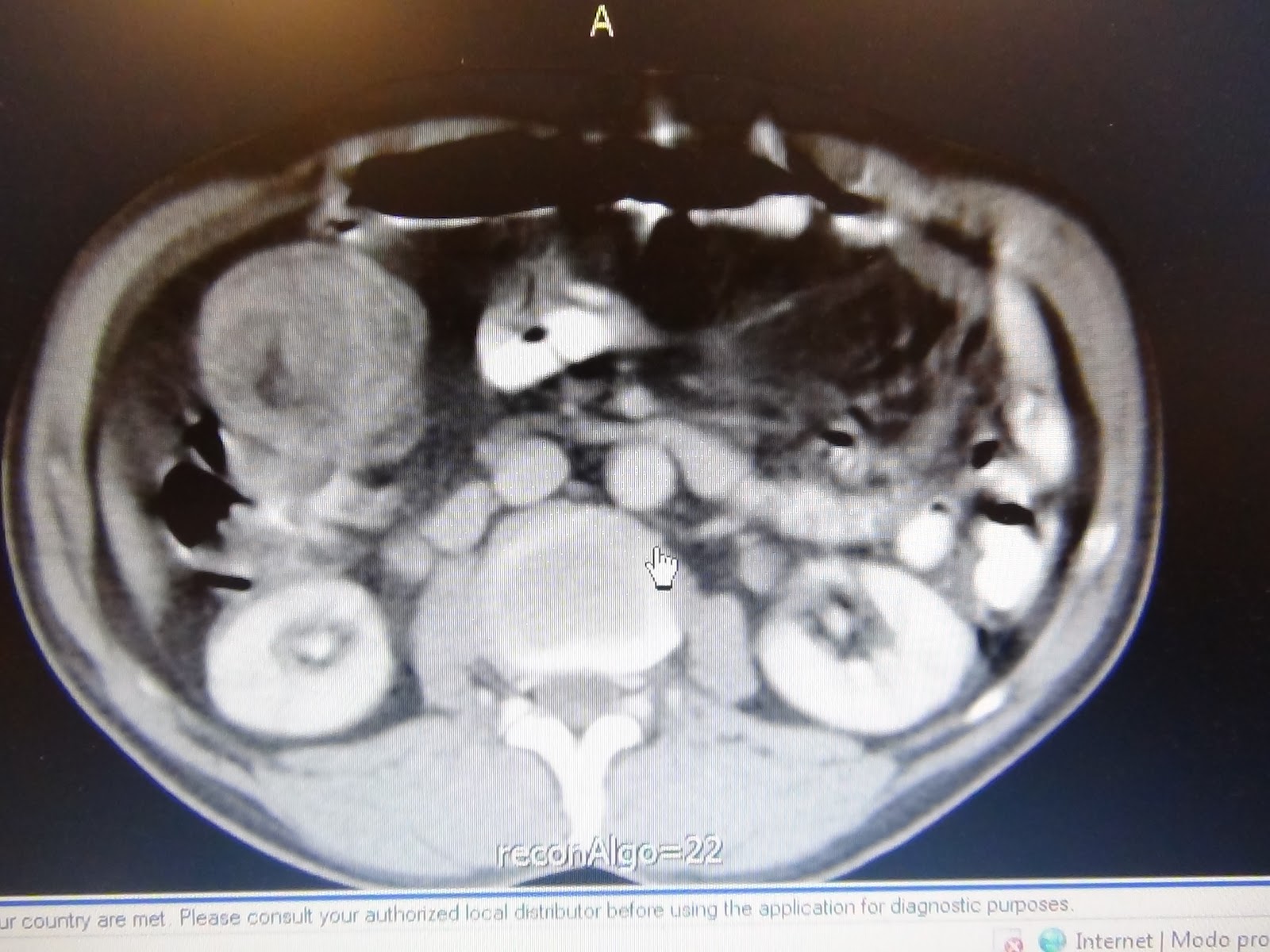 Endoscopia y Cirugía Digestiva: CANCER POLIPOIDE EN COLON DERECHO