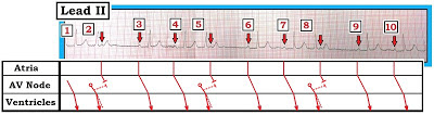 ECG Interpretation: ECG Blog #69 (Laddergrams – Group Beating)