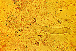 Blog del Laboratorio clinico : Cilindro cereo