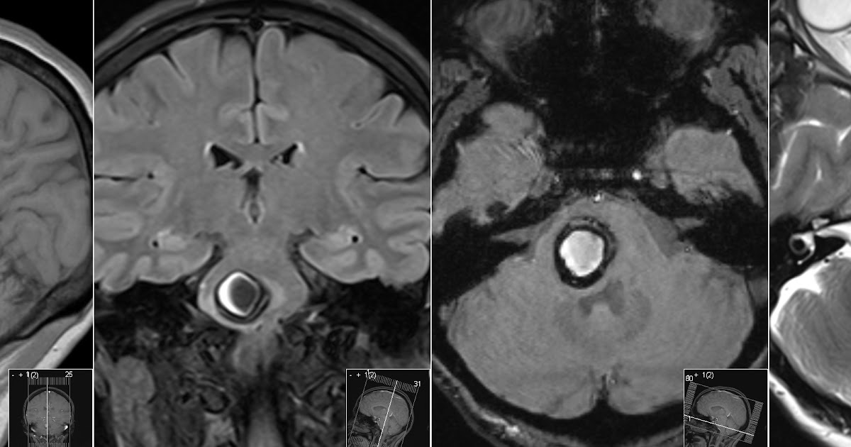 Radiology MRI: Pontine Cavernoma