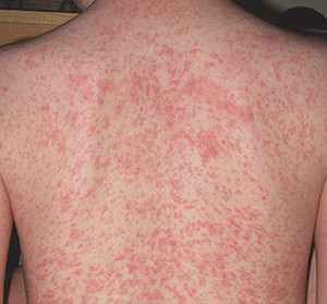 Study Medical Photos: A Patient Presents With Maculopapular Rash Of ...