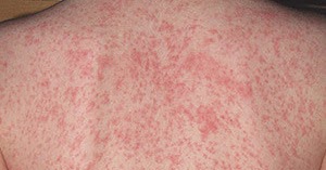 Study Medical Photos: A Patient Presents With Maculopapular Rash Of ...
