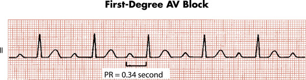 First degree atrioventricular block - ECG First degree atrioventricular block - ECG