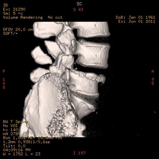 X-RAYview: Traumatismo da COLUNA LOMBAR