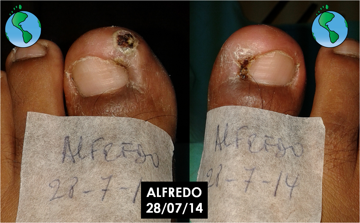 PODOLOGIA: LOS PIES SOBRE LA TIERRA #homeconsultingroom: ONICOCRIPTOSIS ...