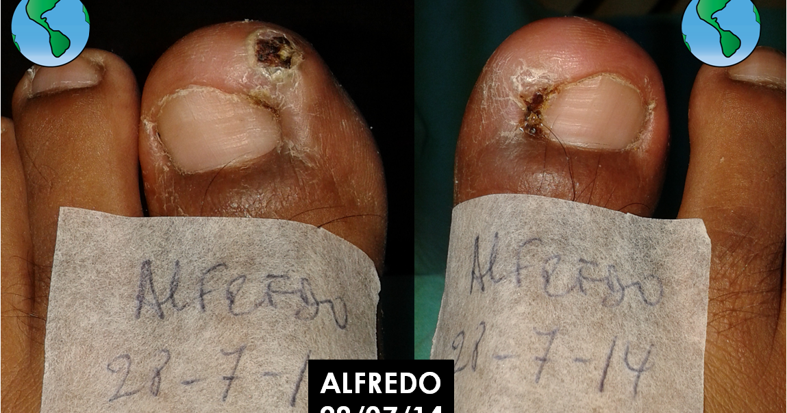 PODOLOGIA: LOS PIES SOBRE LA TIERRA: ONICOCRIPTOSIS de IV GRADO