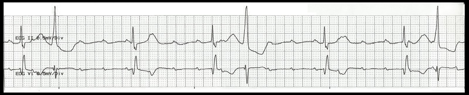 Practice EKG Rhythm Strips 176