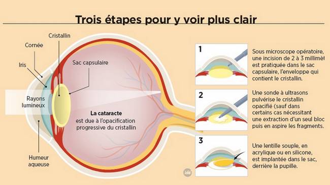 Cataracte opacification du cristallin, causes, symptômes