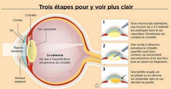 Cataracte opacification du cristallin, causes, symptômes