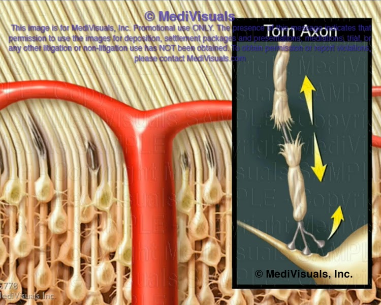 The Medical Legal Exhibit Expert Blog: Understanding Traumatic Brain ...