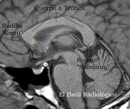 El Baúl Radiológico: EL CUERPO CALLOSO NORMAL. VARIANTES ANATÓMICAS ...