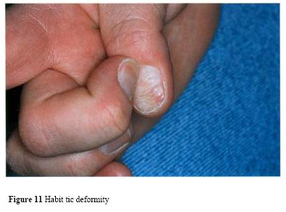 Nail Diseases: Habit Tic Deformity