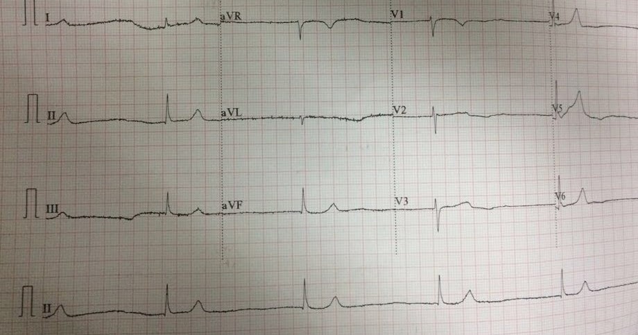 Cardiology window: Severe sinus node dysfunction with junctional ...