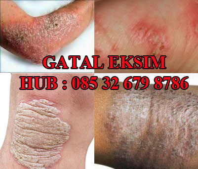 Gejala Dan Cirikhas Eksim Pada Manusia | Tips Sehat Tanpa Obat