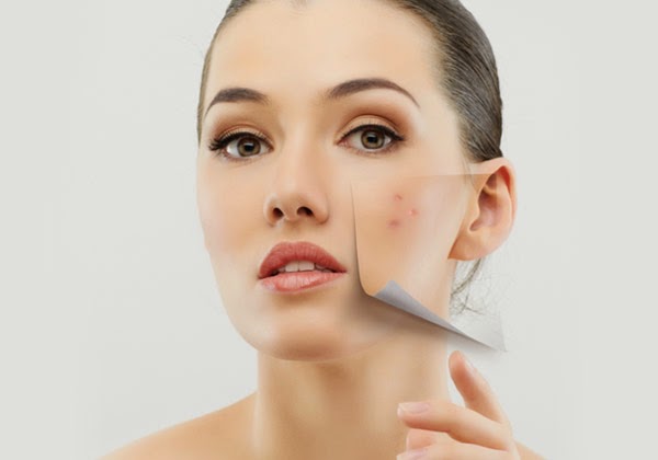 How To Remove Acne Or Pimple Marks Or Dark Spots At Home Top Fashion how-to-remove-acne-or-pimple-marks-or-dark-spots-at-home-top-fashion