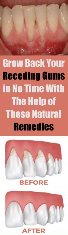 Daily Health Advisor : Grow Back Your Receding Gums In No Time With The ...
