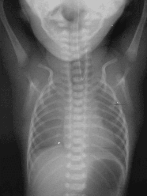 RADIOLOGY IMAGE SPOTTERS: Esophageal atresia, TEF