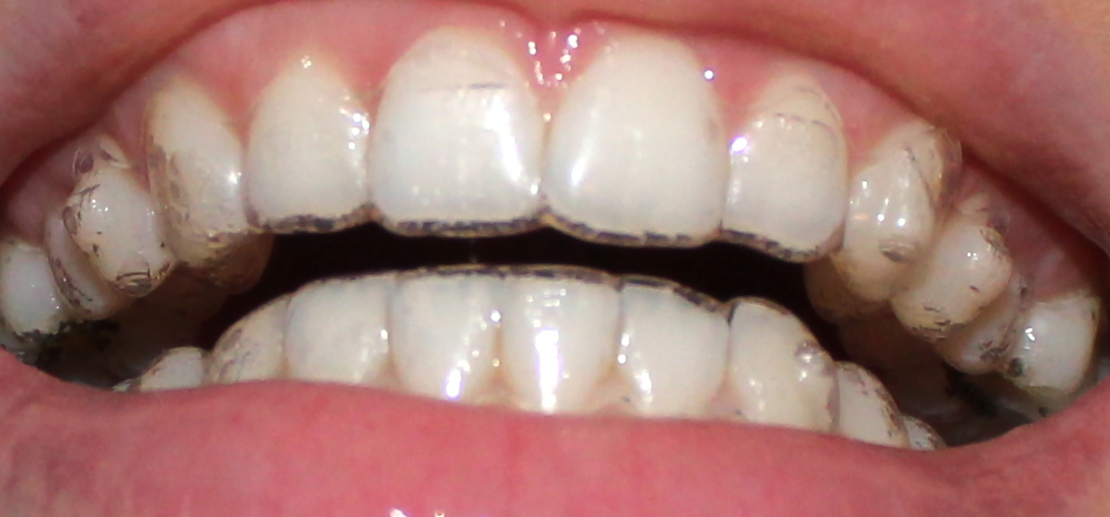 Invisalign - Update | Natalya's Beauty Blog- Filthygorgeousmakeup