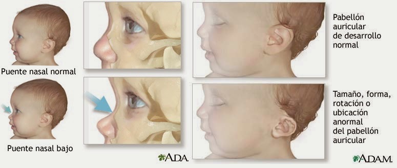 Síndrome de Opitz C - Ciencia Bizarra