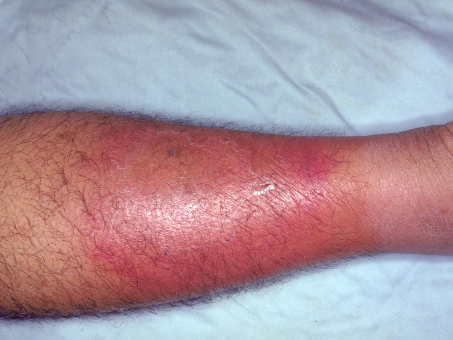 CELLULITIS : DEFINITION , CLINICAL FEATURES ,TREATMENT & COMPLICATIONS ...
