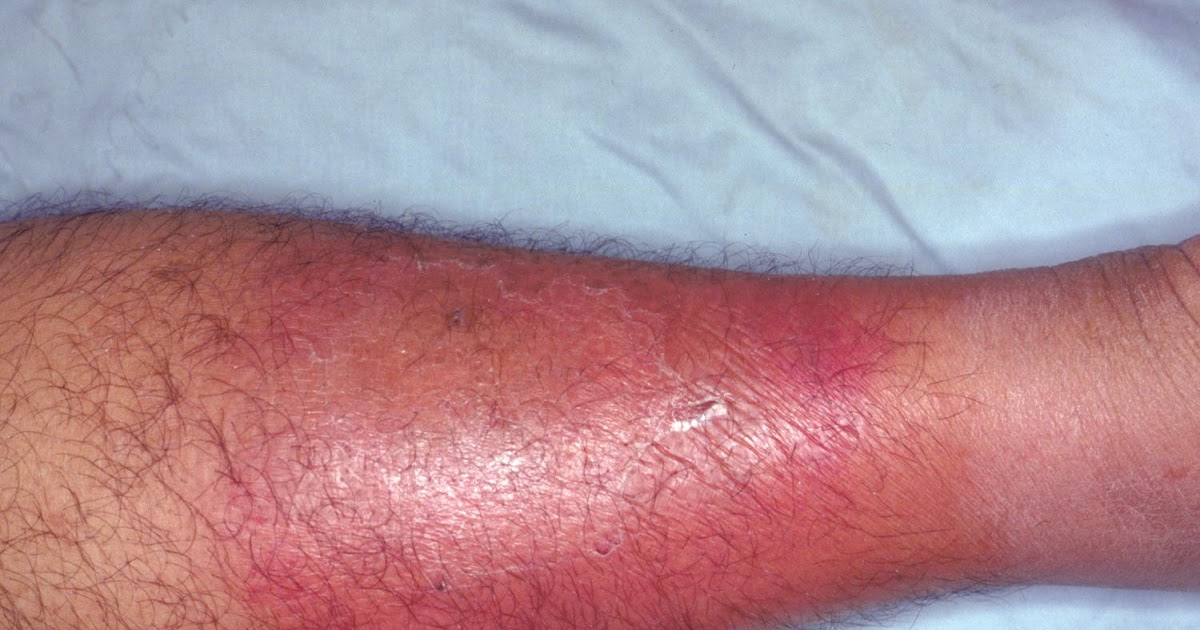 CELLULITIS : DEFINITION , CLINICAL FEATURES ,TREATMENT & COMPLICATIONS ...