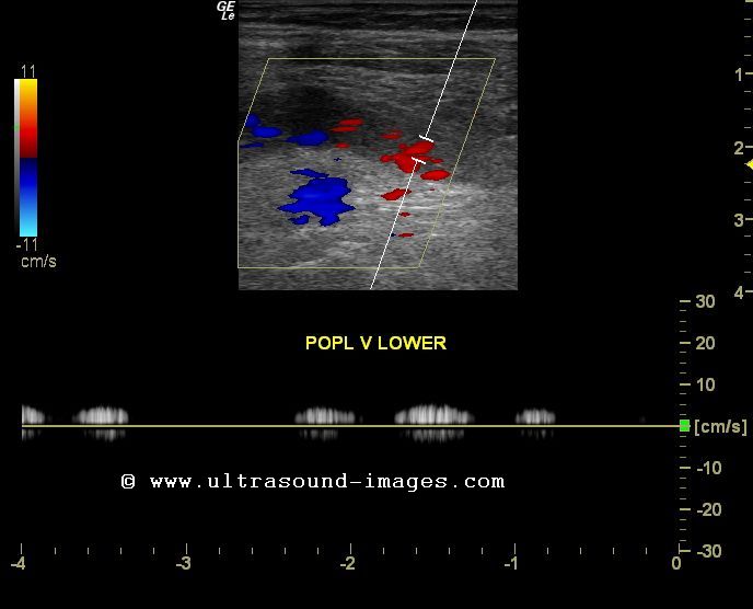 cochinblogs: Ultrasound imaging of popliteal vein thrombosis