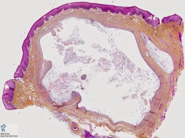 Estomatologia Online: Mucocele, Rânula e Sialolitíase